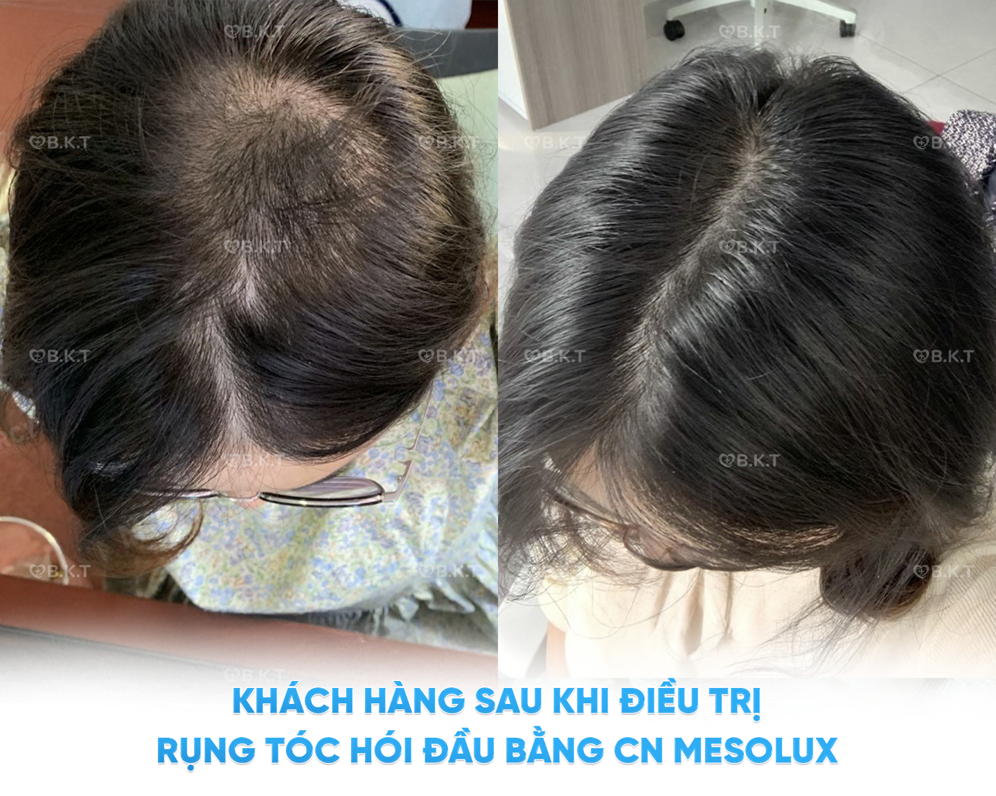 Bác sĩ Bùi Kiều Trang hướng dẫn điều trị rụng tóc kéo dài ở giới trẻ